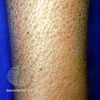 Winter and your skin - Western Skin Institute